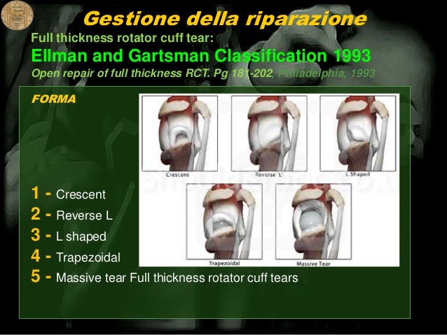 Ortopedico Dottore Marco Spoliti Gestione lesioni di cuffia rotatori