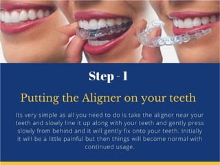 Get straight teeth without braces by invisalign