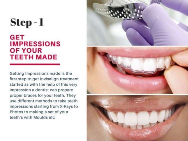 Get straight teeth without braces by invisalign