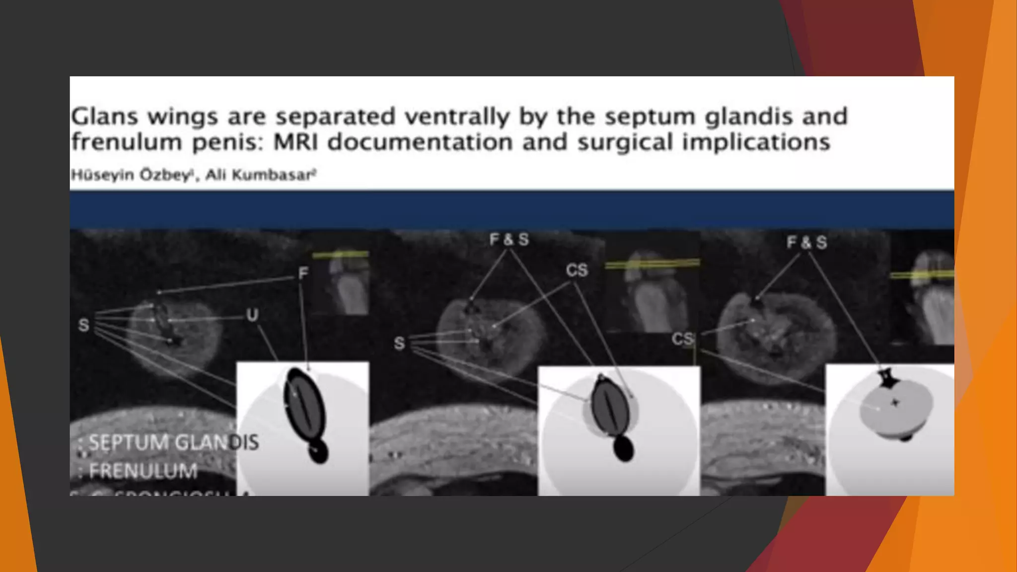 Journal Club 'Hypospadias repair with the glanular-frenular collar (GFC ...