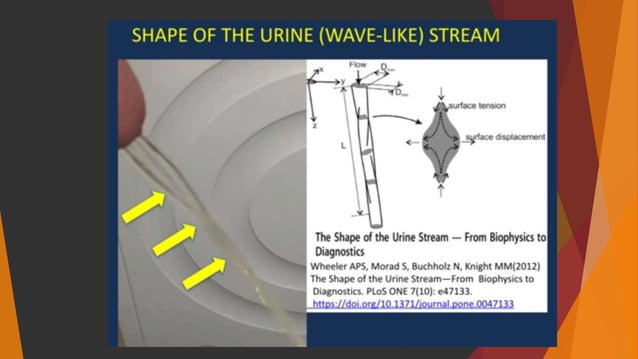 Journal Club 'Hypospadias repair with the glanular-frenular collar (GFC ...