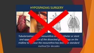 Journal Club 'Hypospadias repair with the glanular-frenular collar (GFC ...