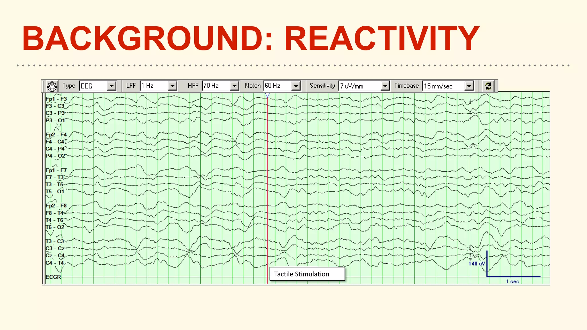 Continuous EEG in Neuro Critical Care by Brandon Foreman | PDF