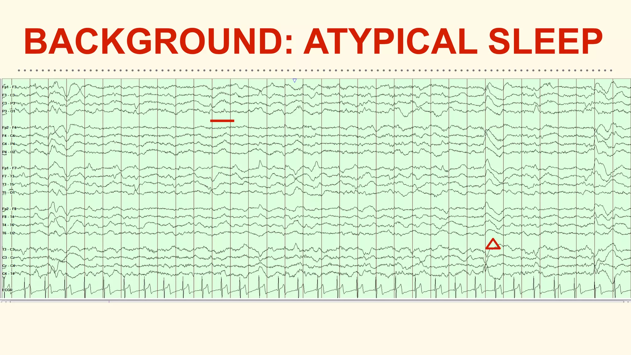Continuous EEG in Neuro Critical Care by Brandon Foreman | PDF