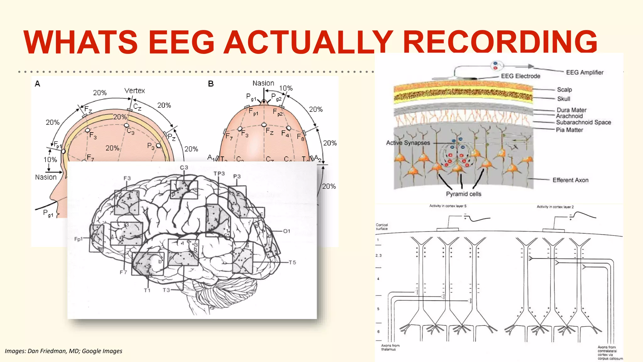 Continuous EEG in Neuro Critical Care by Brandon Foreman | PDF