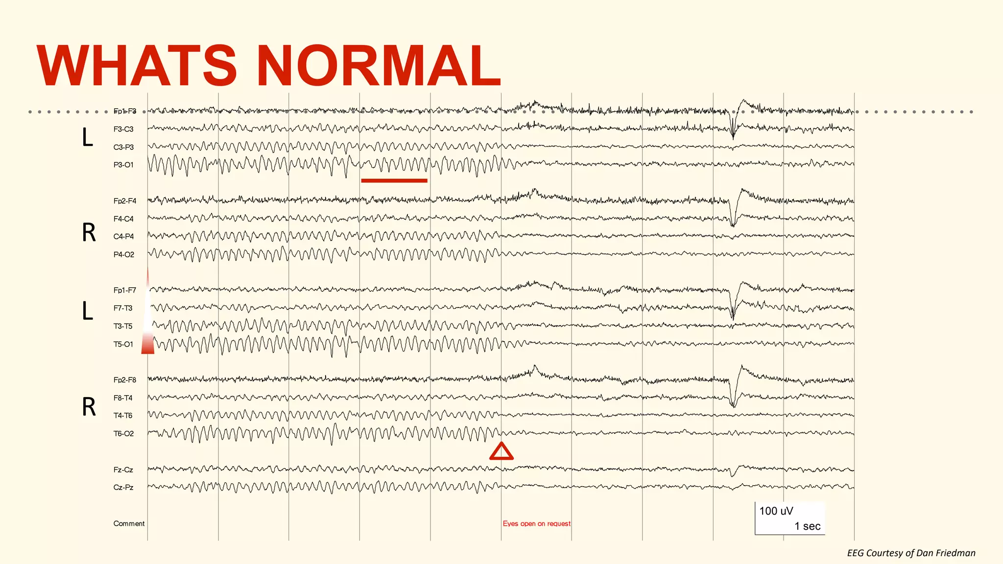 Continuous EEG in Neuro Critical Care by Brandon Foreman | PDF