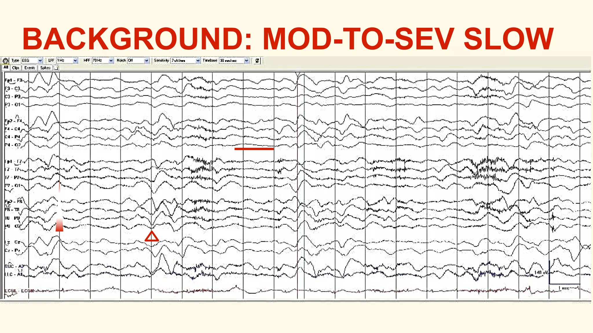 Continuous EEG in Neuro Critical Care by Brandon Foreman | PDF