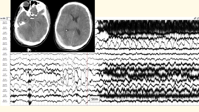 Continuous EEG in Neuro Critical Care by Brandon Foreman | PDF | Brain ...