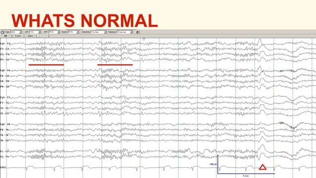 Continuous EEG in Neuro Critical Care by Brandon Foreman | PDF | Brain ...