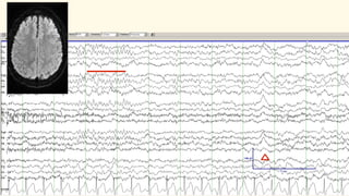 Continuous EEG in Neuro Critical Care by Brandon Foreman | PDF