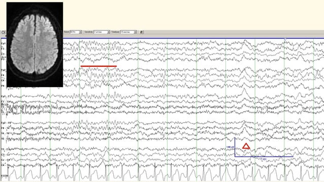 Continuous EEG in Neuro Critical Care by Brandon Foreman | PDF | Brain ...