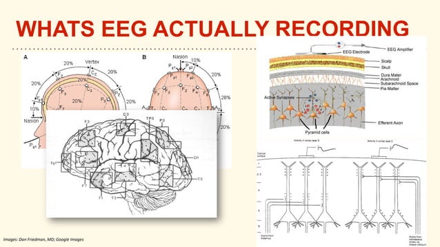 Continuous EEG in Neuro Critical Care by Brandon Foreman | PDF | Brain ...