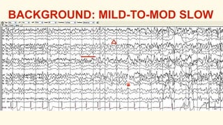 Continuous EEG in Neuro Critical Care by Brandon Foreman | PDF