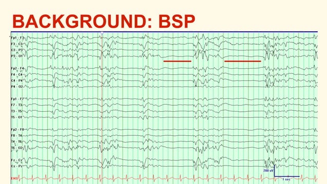 Continuous EEG in Neuro Critical Care by Brandon Foreman | PDF | Brain ...