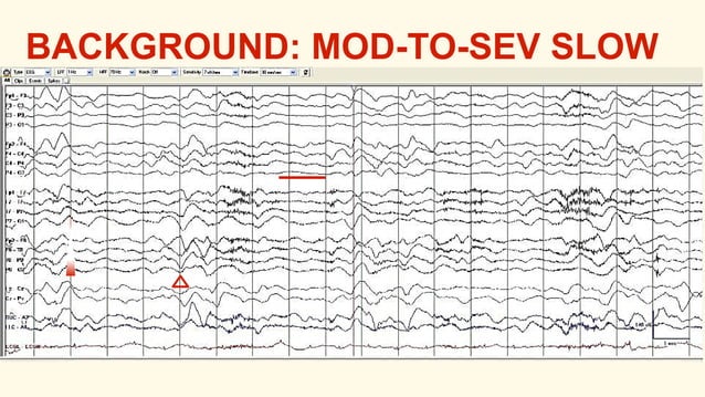 Continuous EEG in Neuro Critical Care by Brandon Foreman