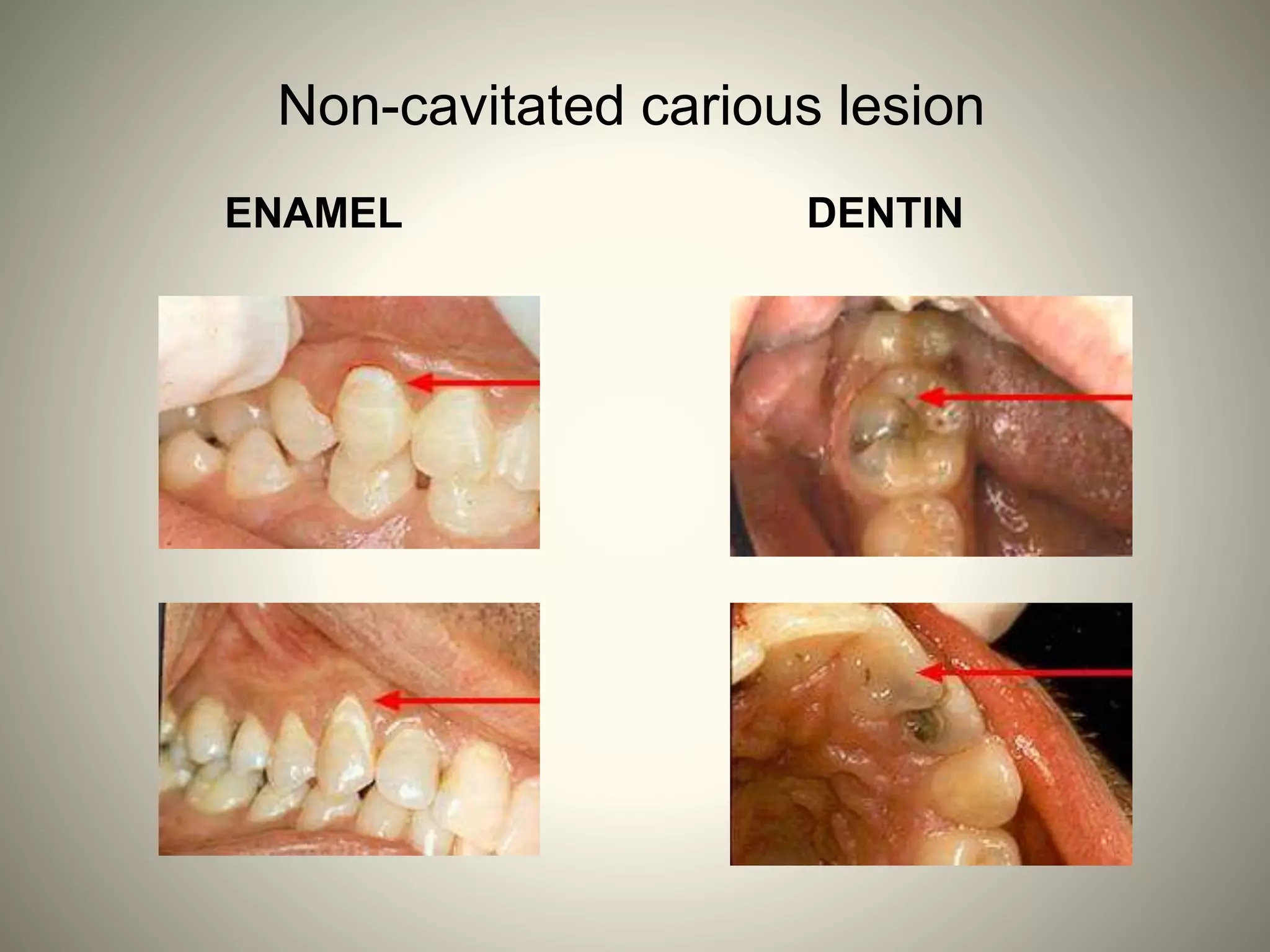 Detection and diagnosis of dental caries | PPTX