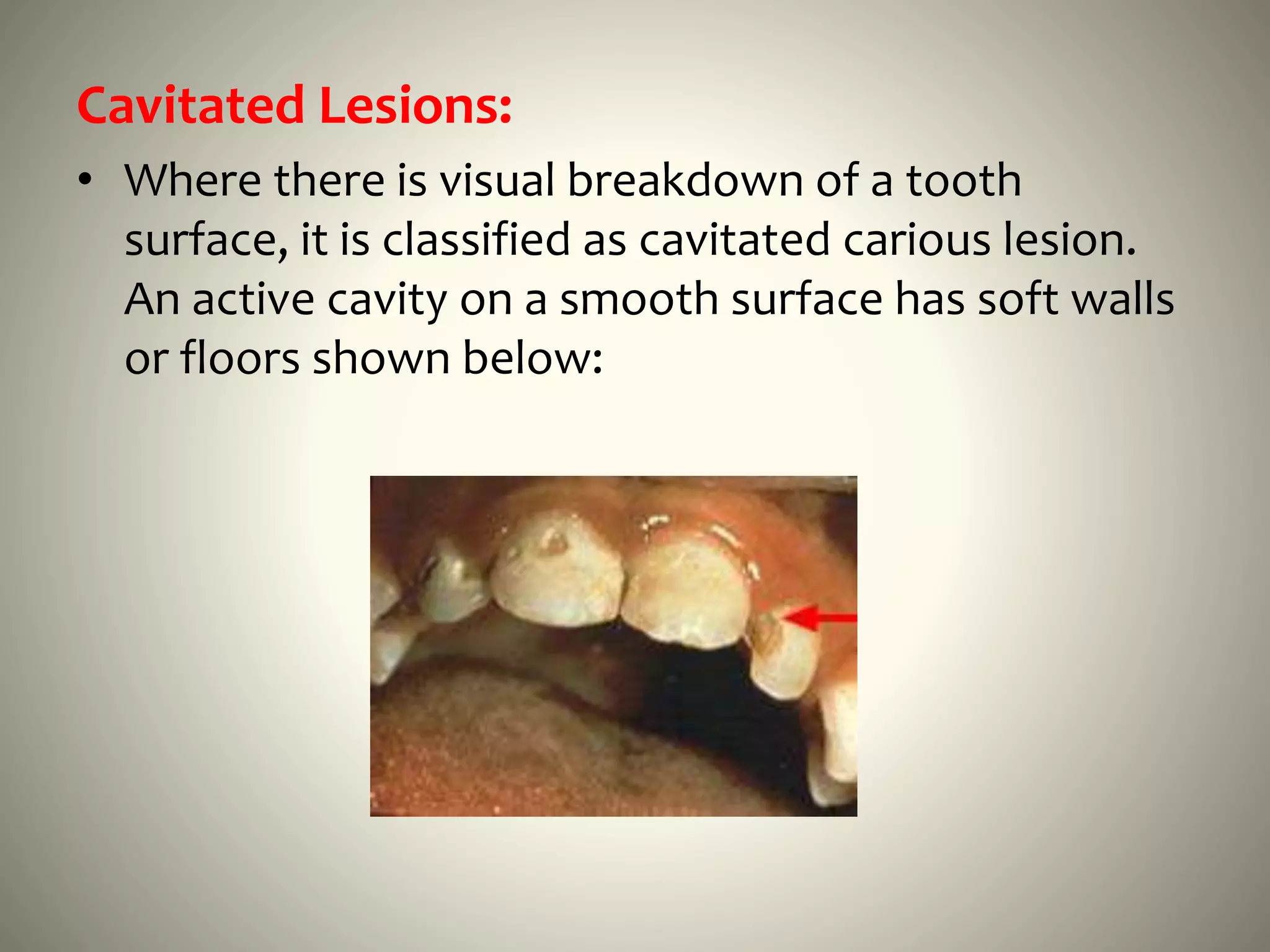 Detection and diagnosis of dental caries | PPTX