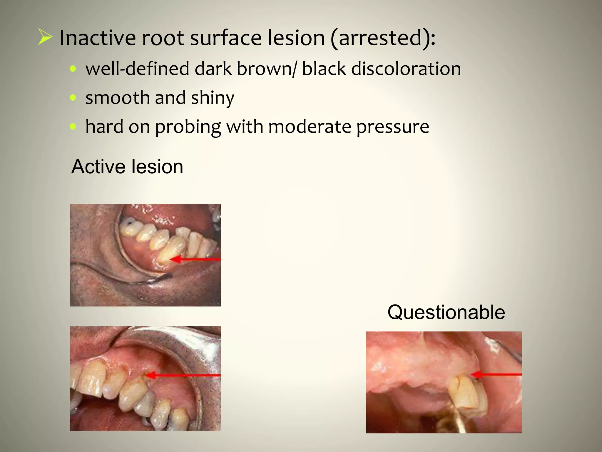 Detection and diagnosis of dental caries | PPTX