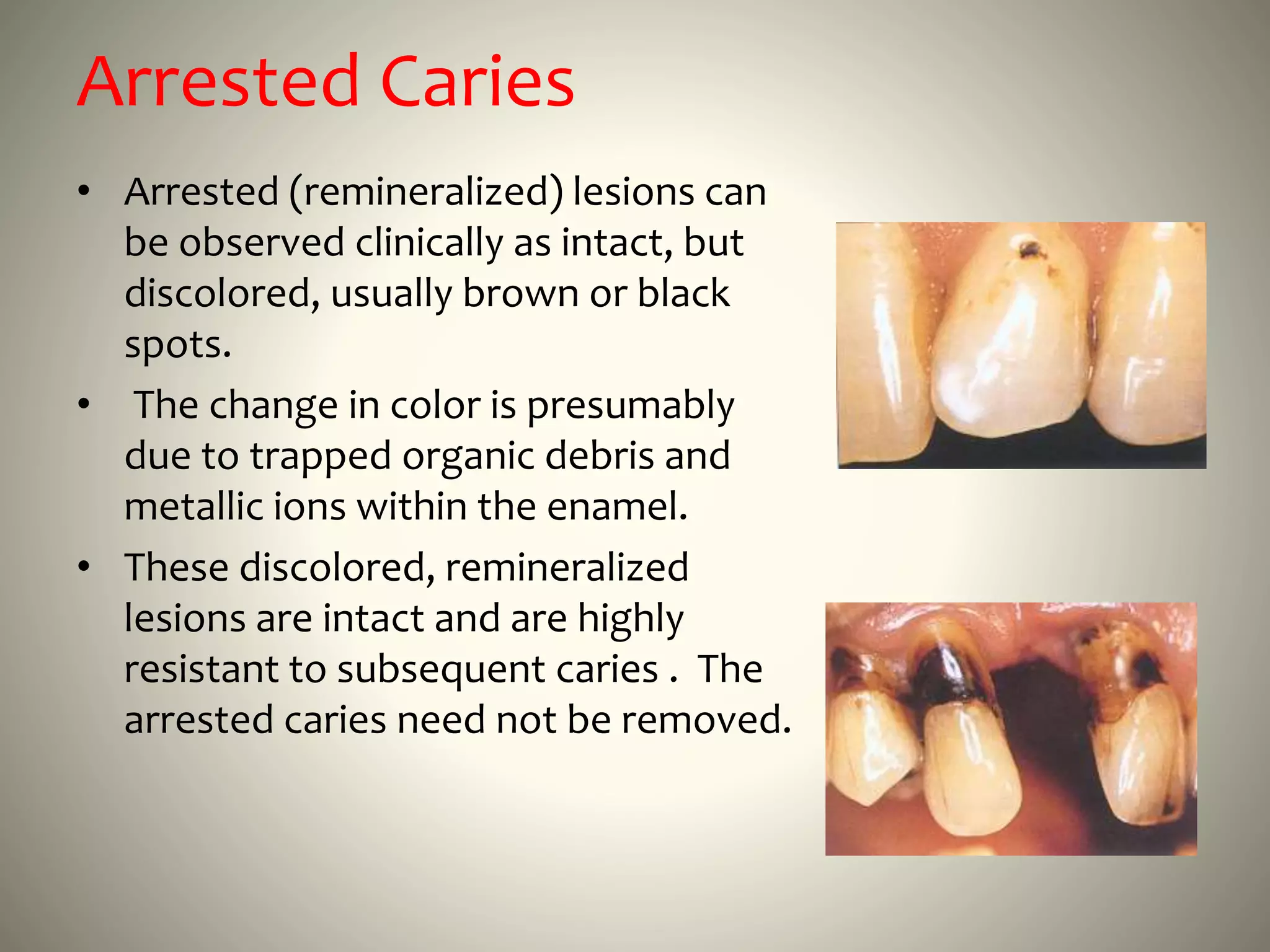 Detection and diagnosis of dental caries | PPTX