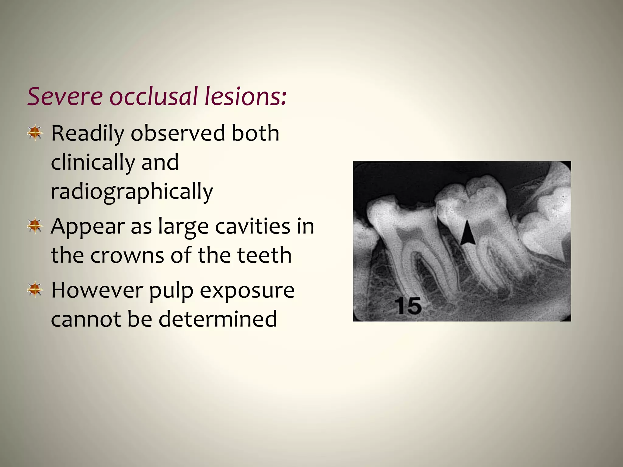 Detection and diagnosis of dental caries | PPTX