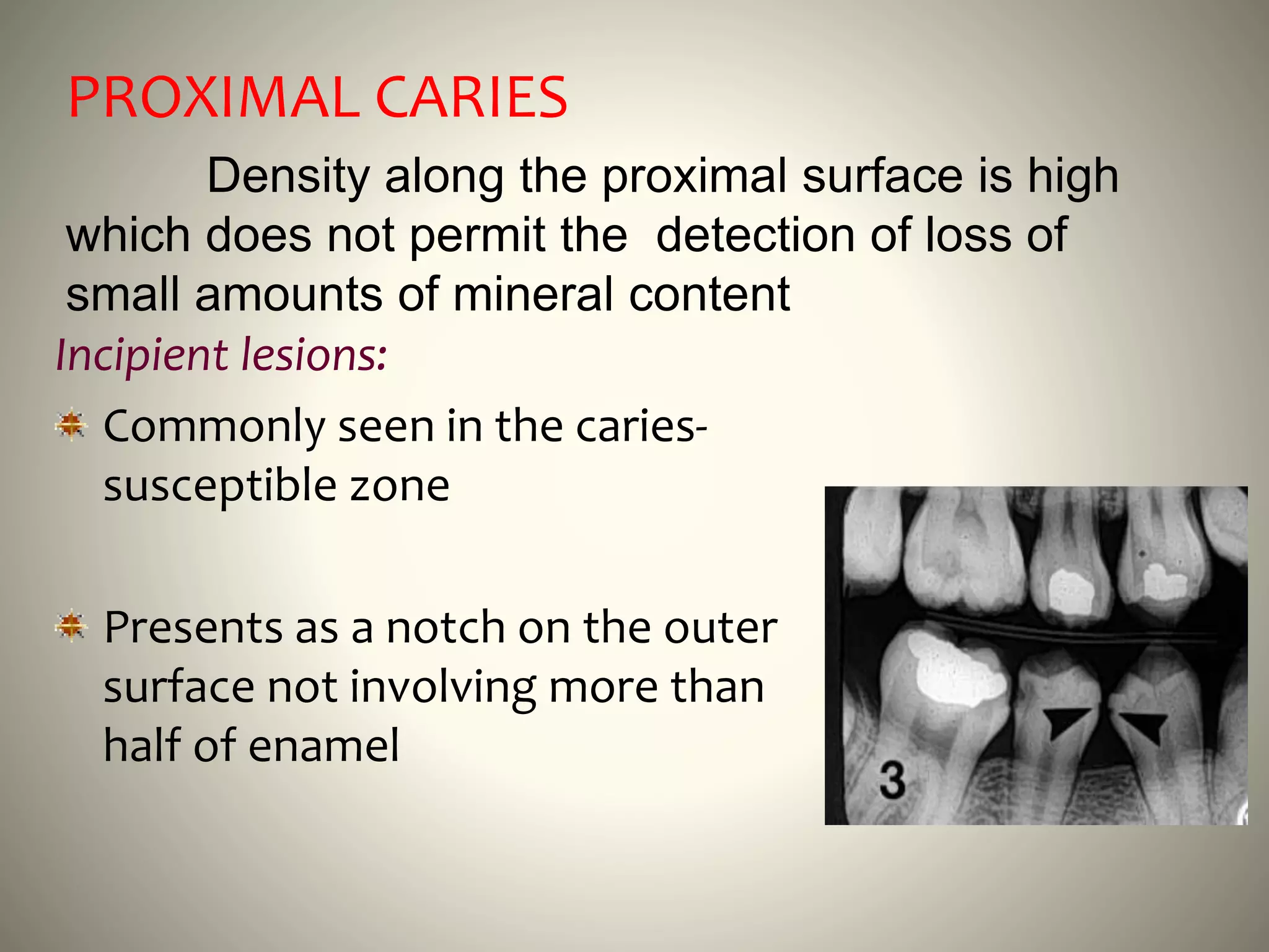Detection And Diagnosis Of Dental Caries Pptx