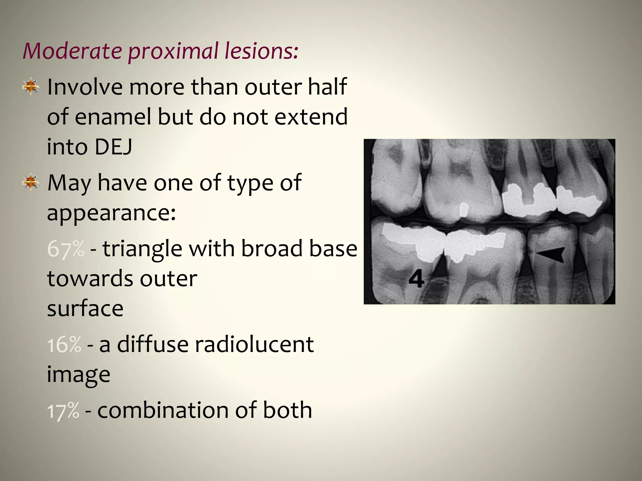 Detection and diagnosis of dental caries | PPTX