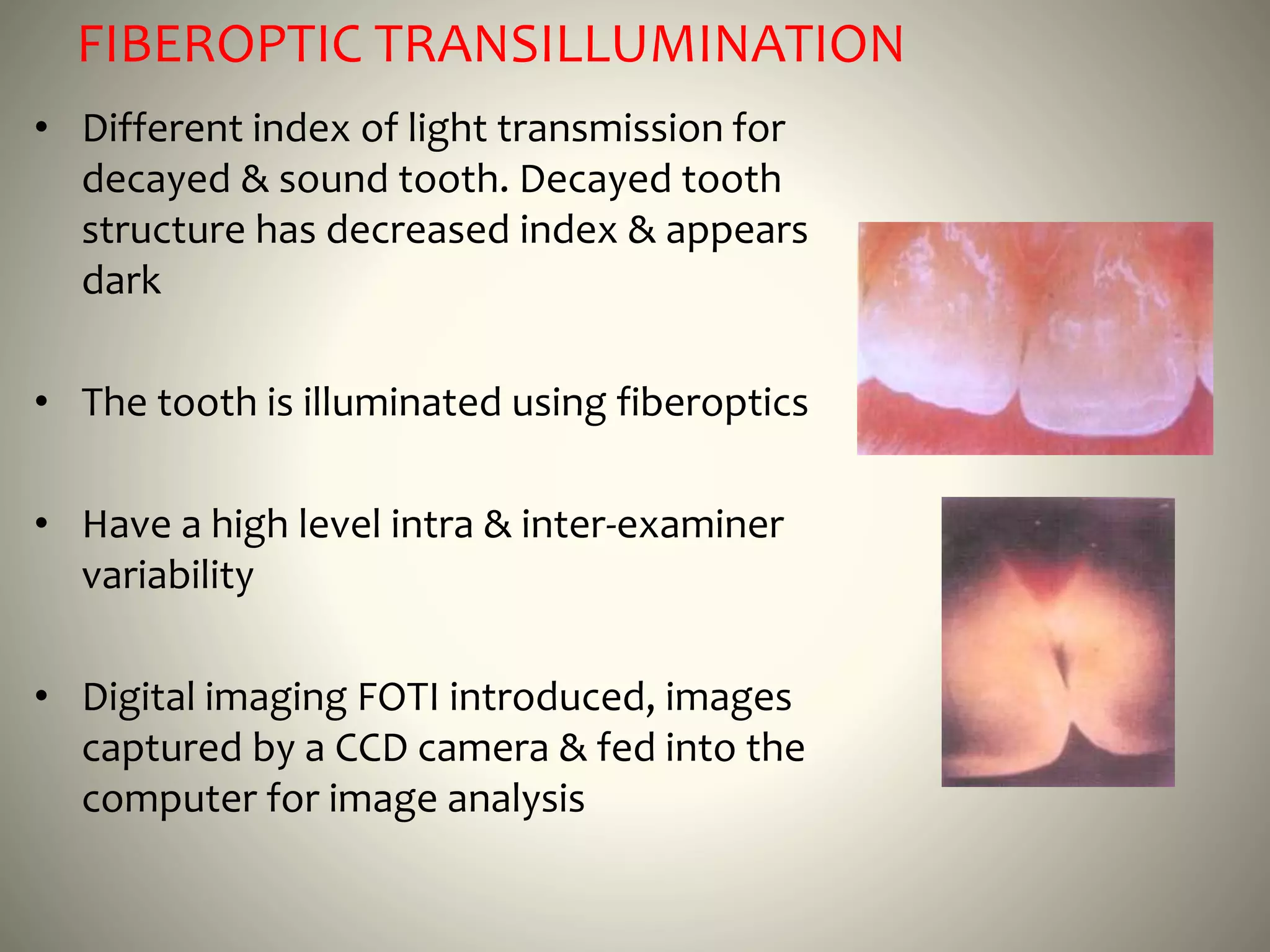 Detection and diagnosis of dental caries | PPTX