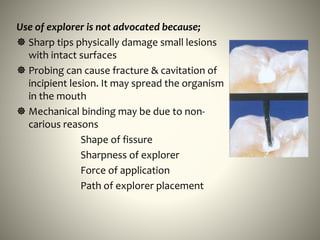 Detection and diagnosis of dental caries | PPTX