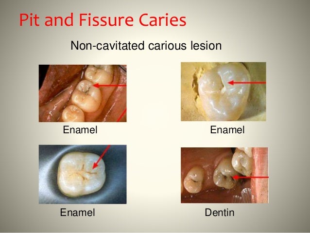 Detection and diagnosis of dental caries
