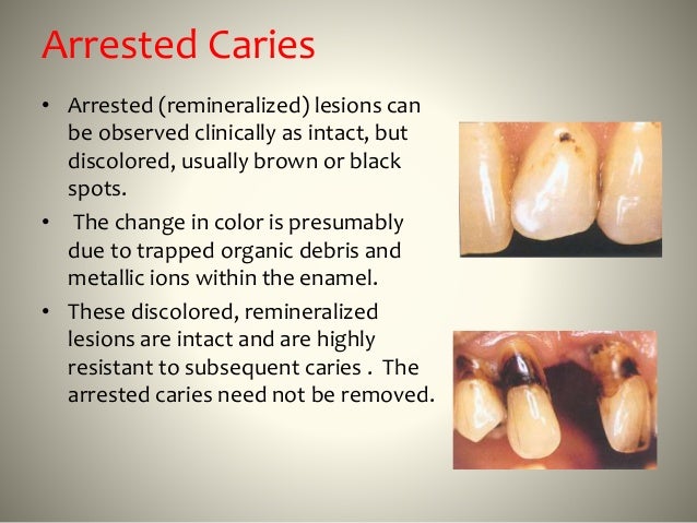 Detection And Diagnosis Of Dental Caries