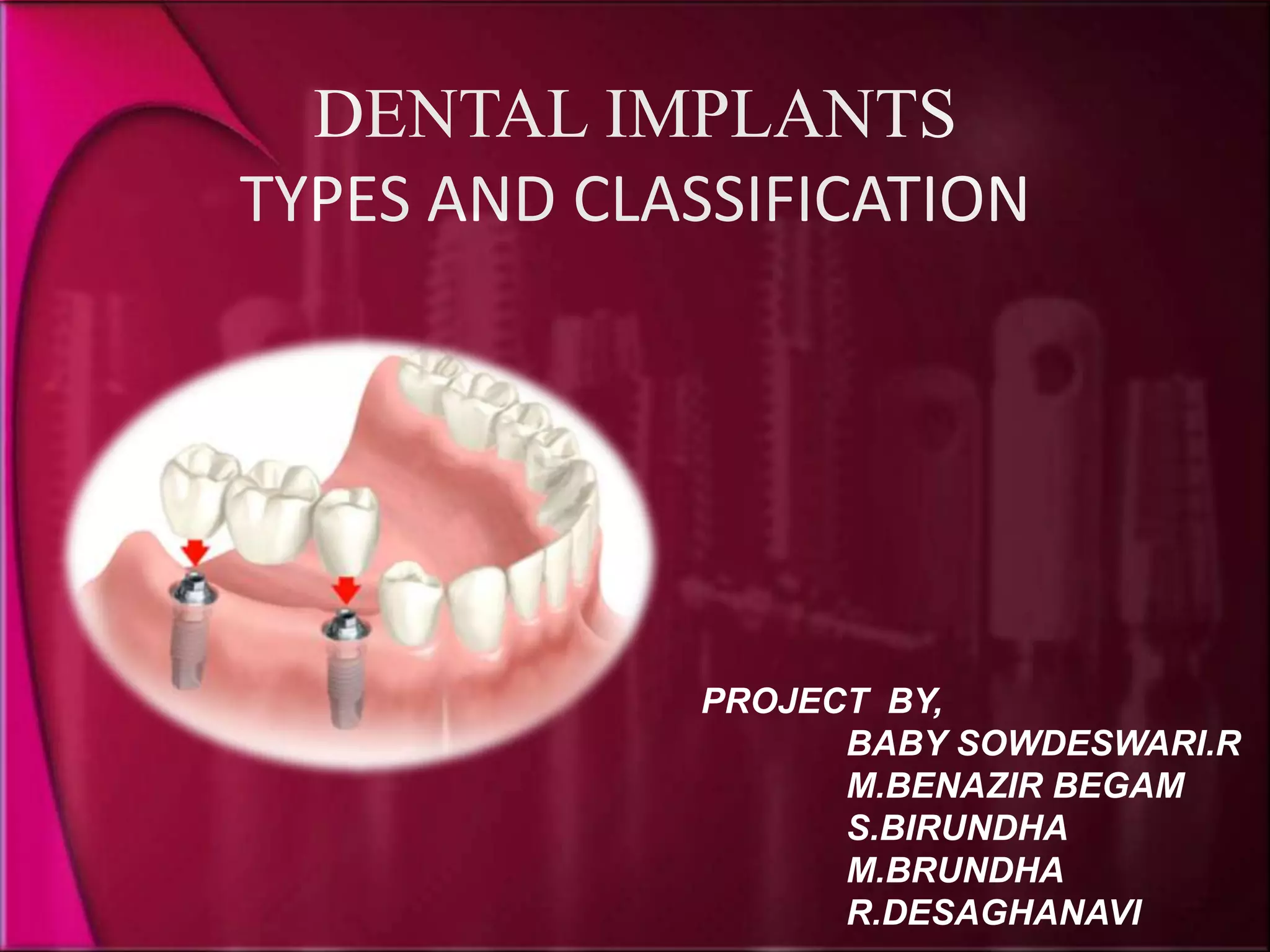 types and classification of dental implants | PPTX