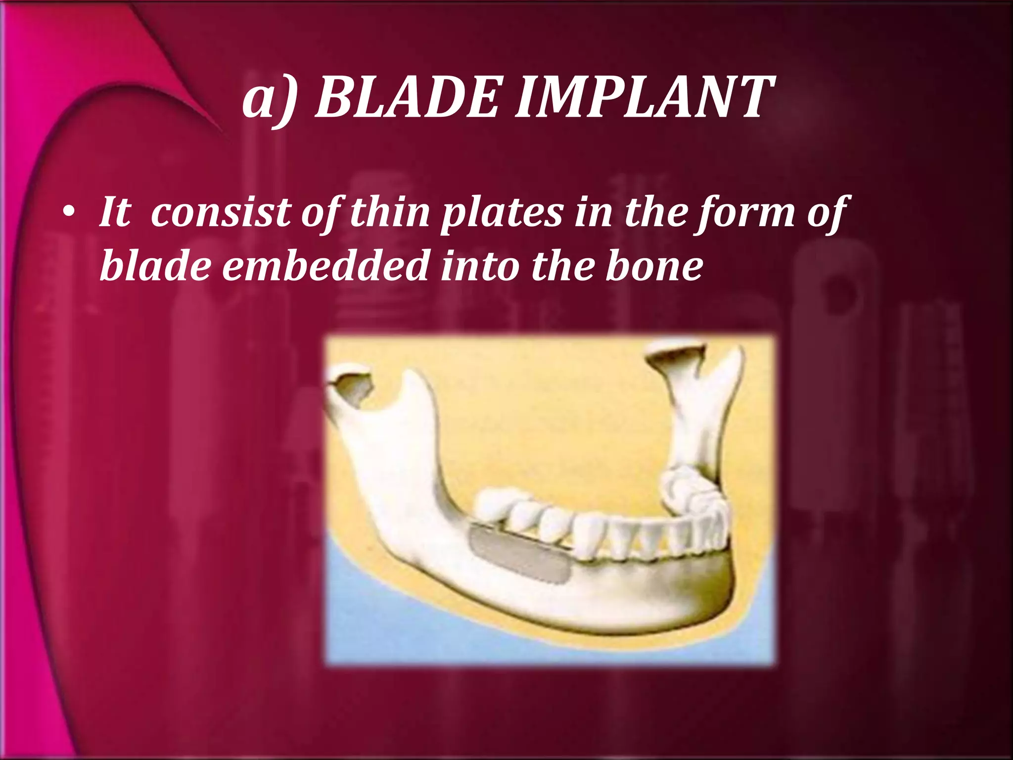 types and classification of dental implants | PPTX