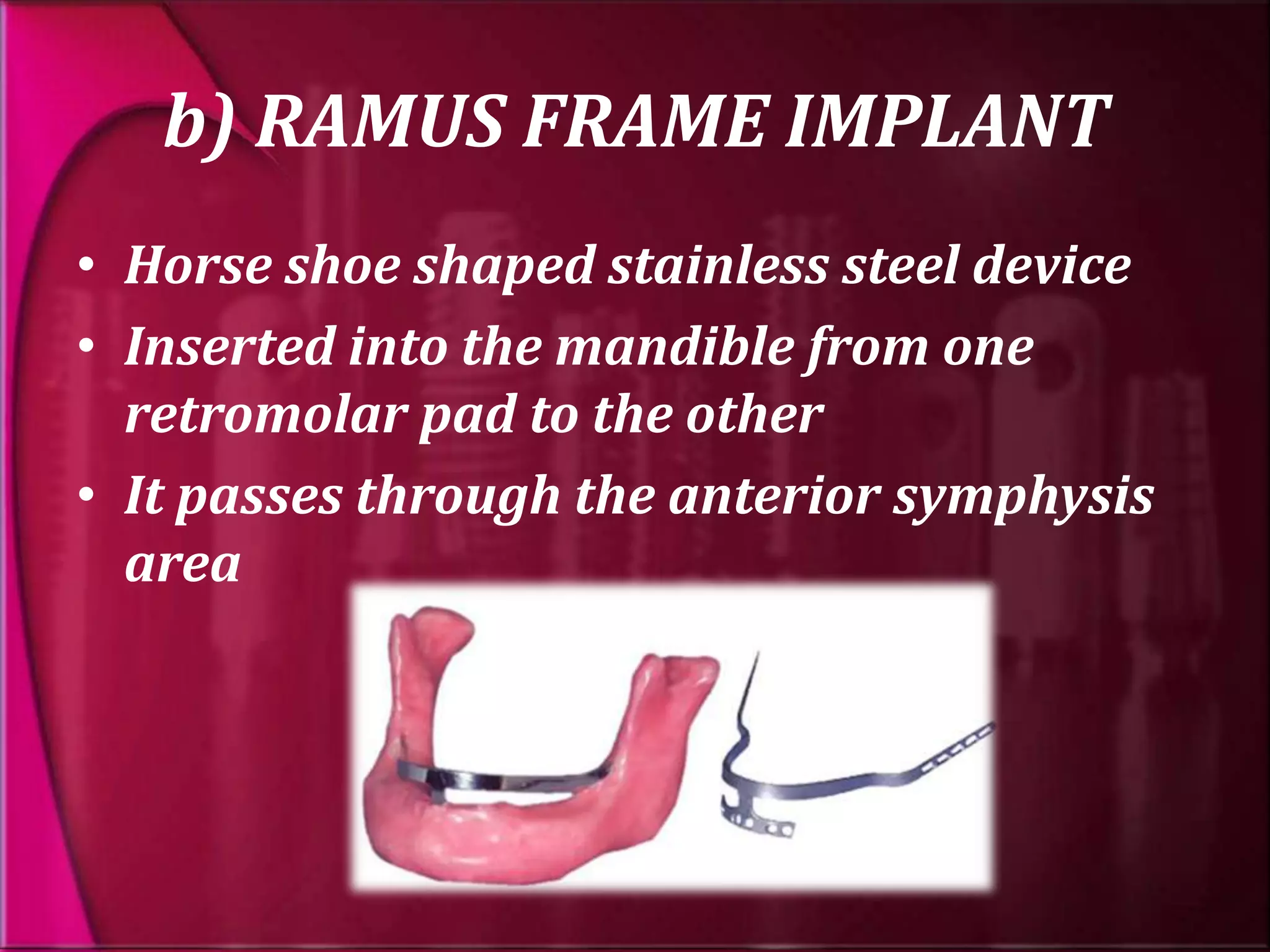 types and classification of dental implants | PPTX
