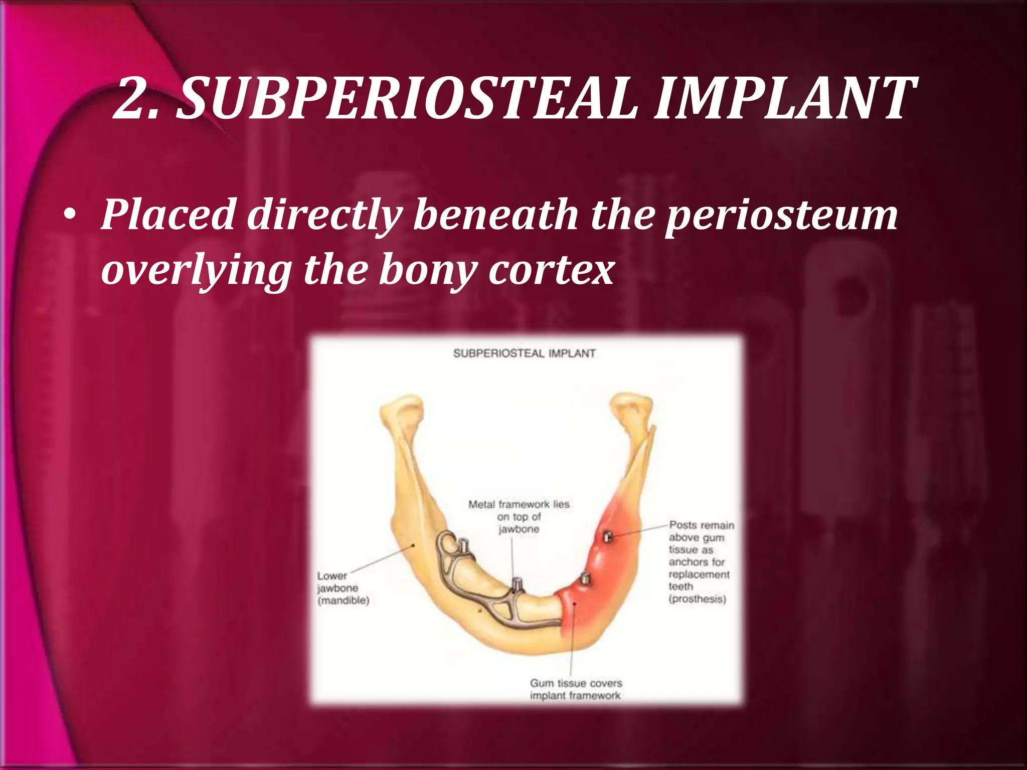 types and classification of dental implants | PPTX