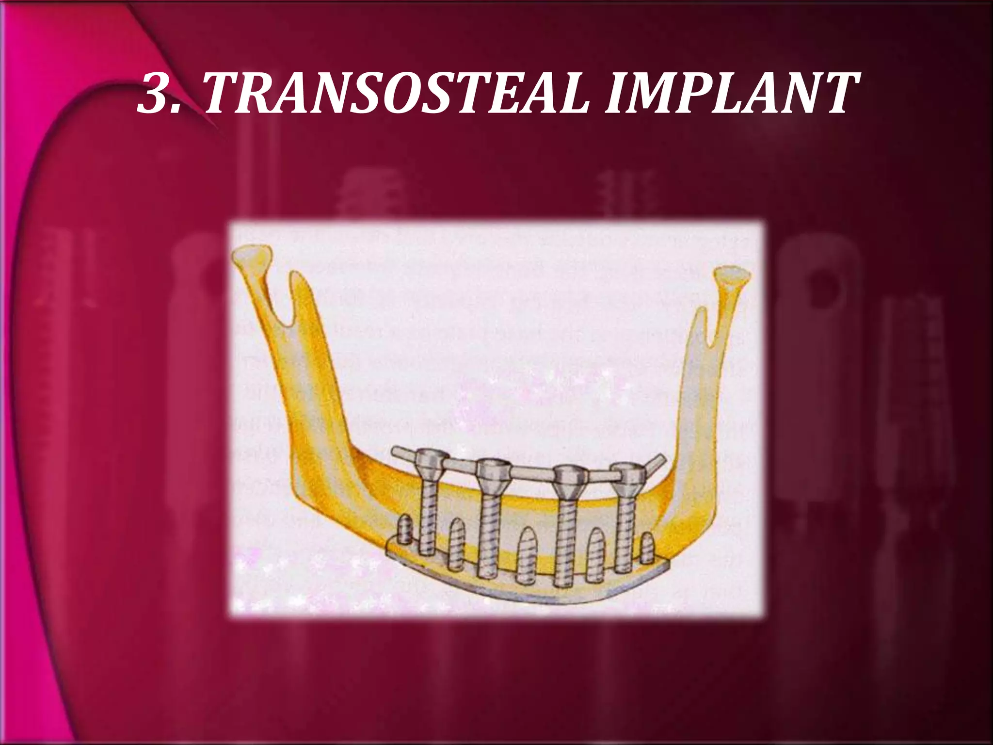 types and classification of dental implants | PPTX