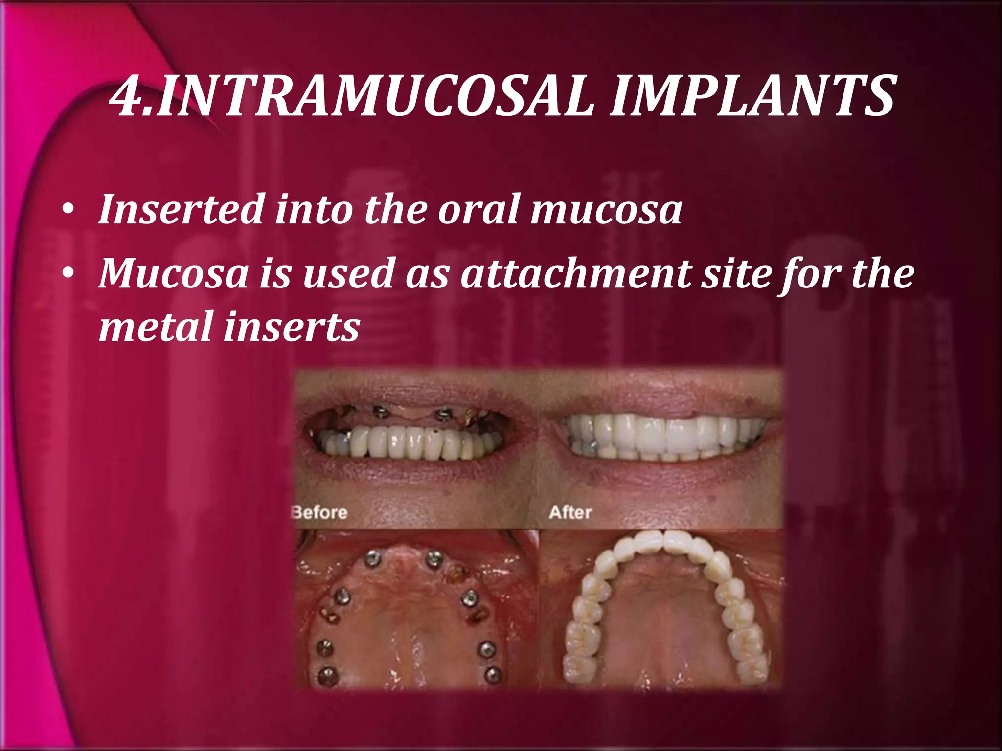 types and classification of dental implants | PPTX