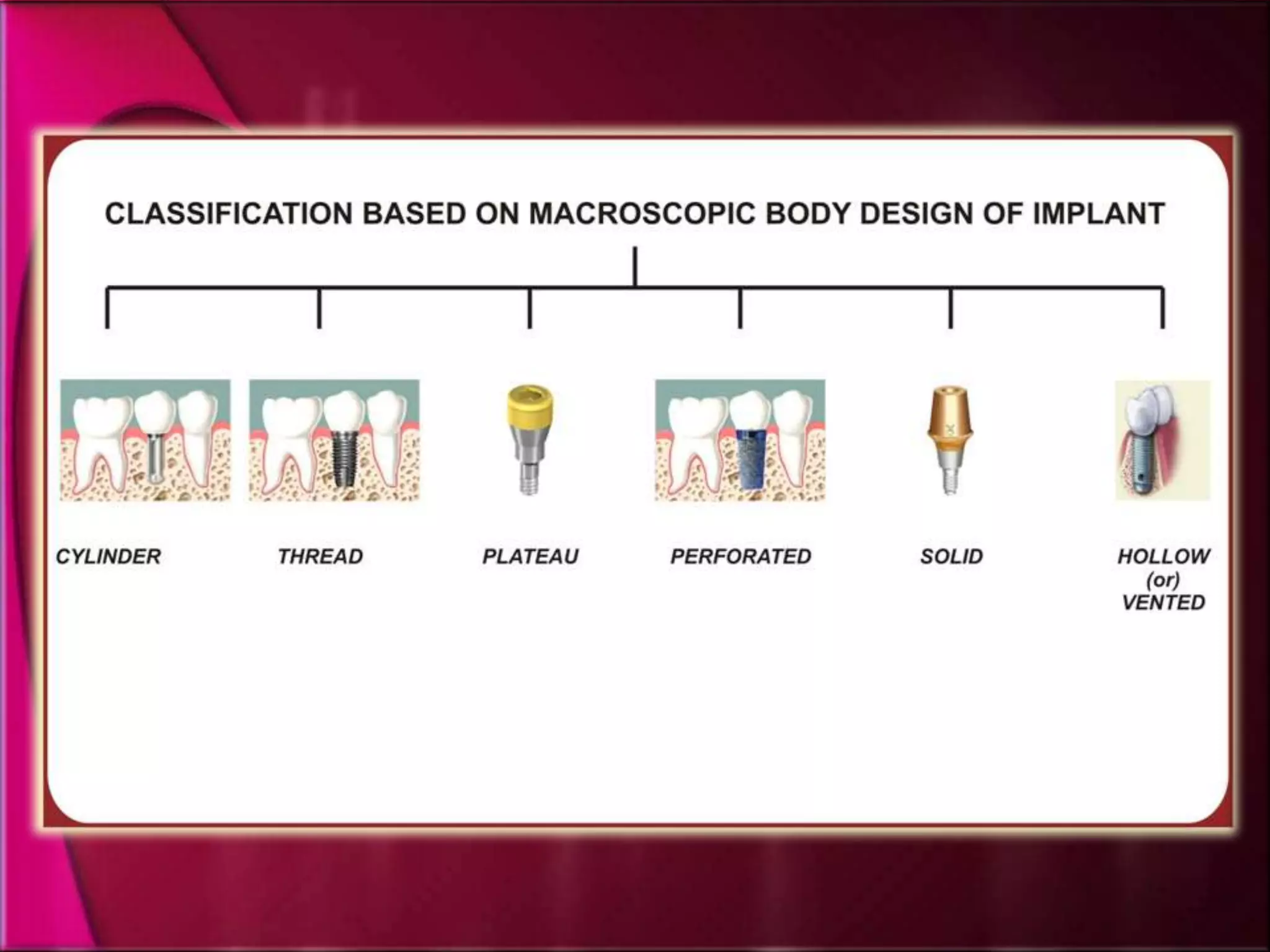 types and classification of dental implants | PPTX