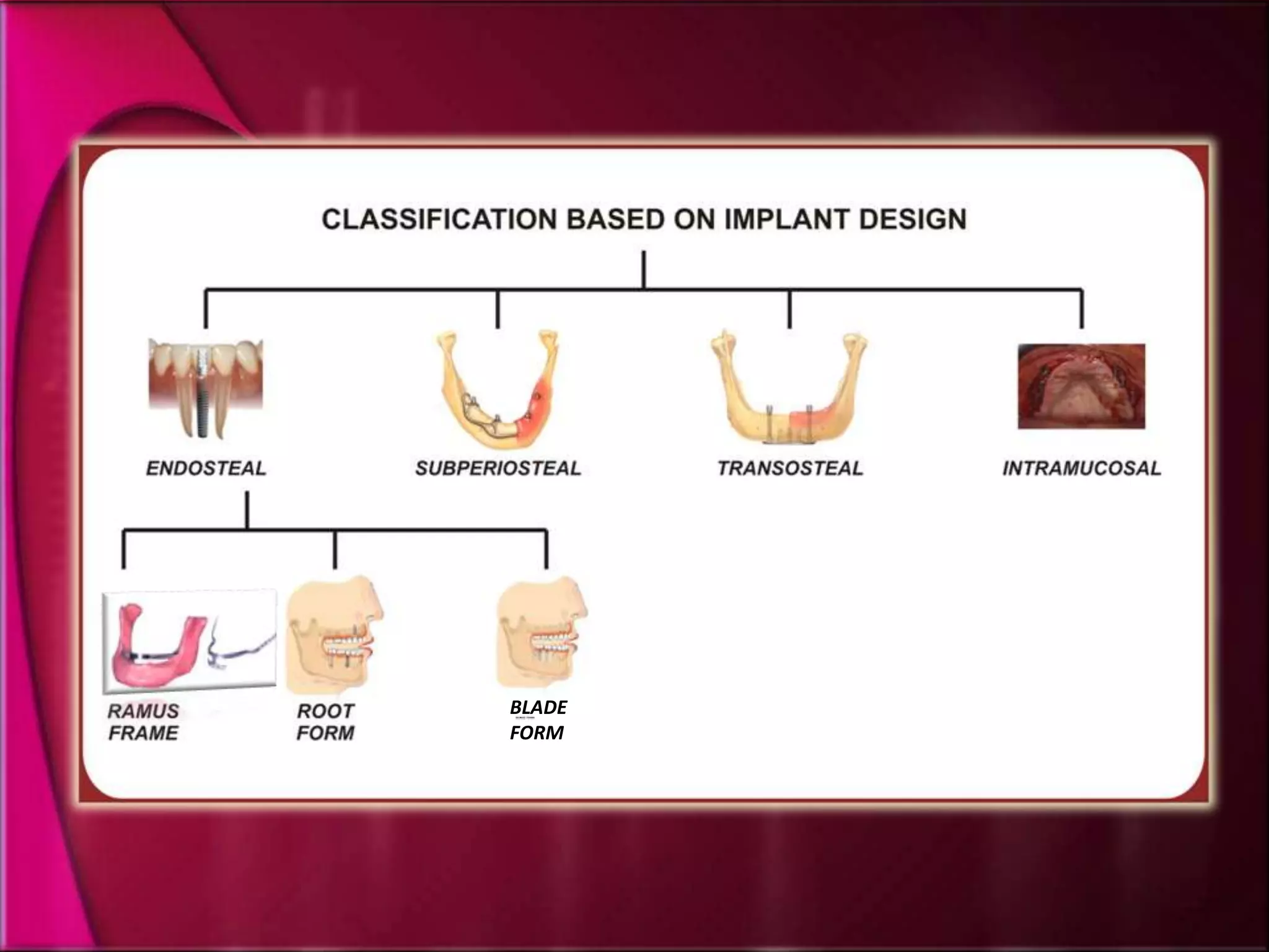 types and classification of dental implants | PPTX