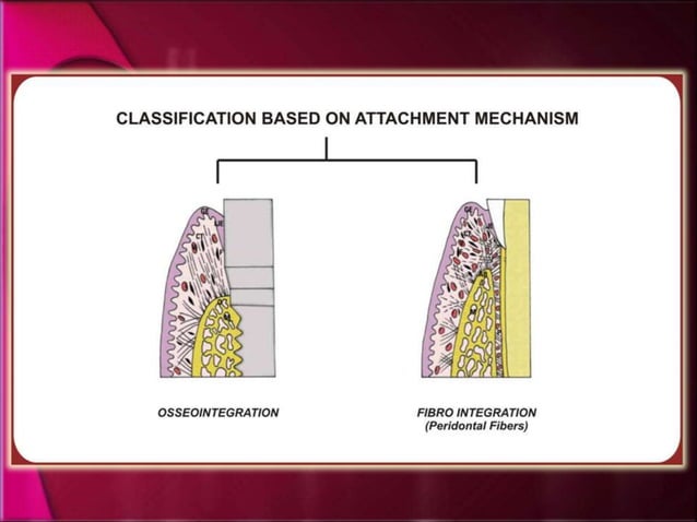 types and classification of dental implants | PPTX | Operating Systems ...