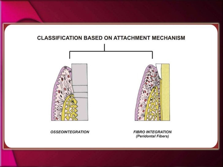 types and classification of dental implants