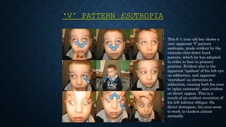 Ghostdogg productions present ~ alphabet pattern strabismus online ...