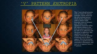 Ghostdogg productions present ~ alphabet pattern strabismus online ...