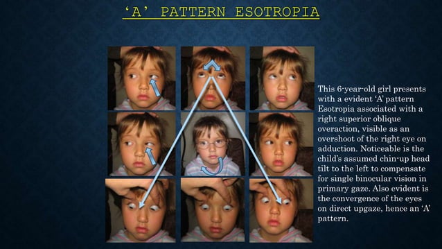 Ghostdogg productions present ~ alphabet pattern strabismus online ...