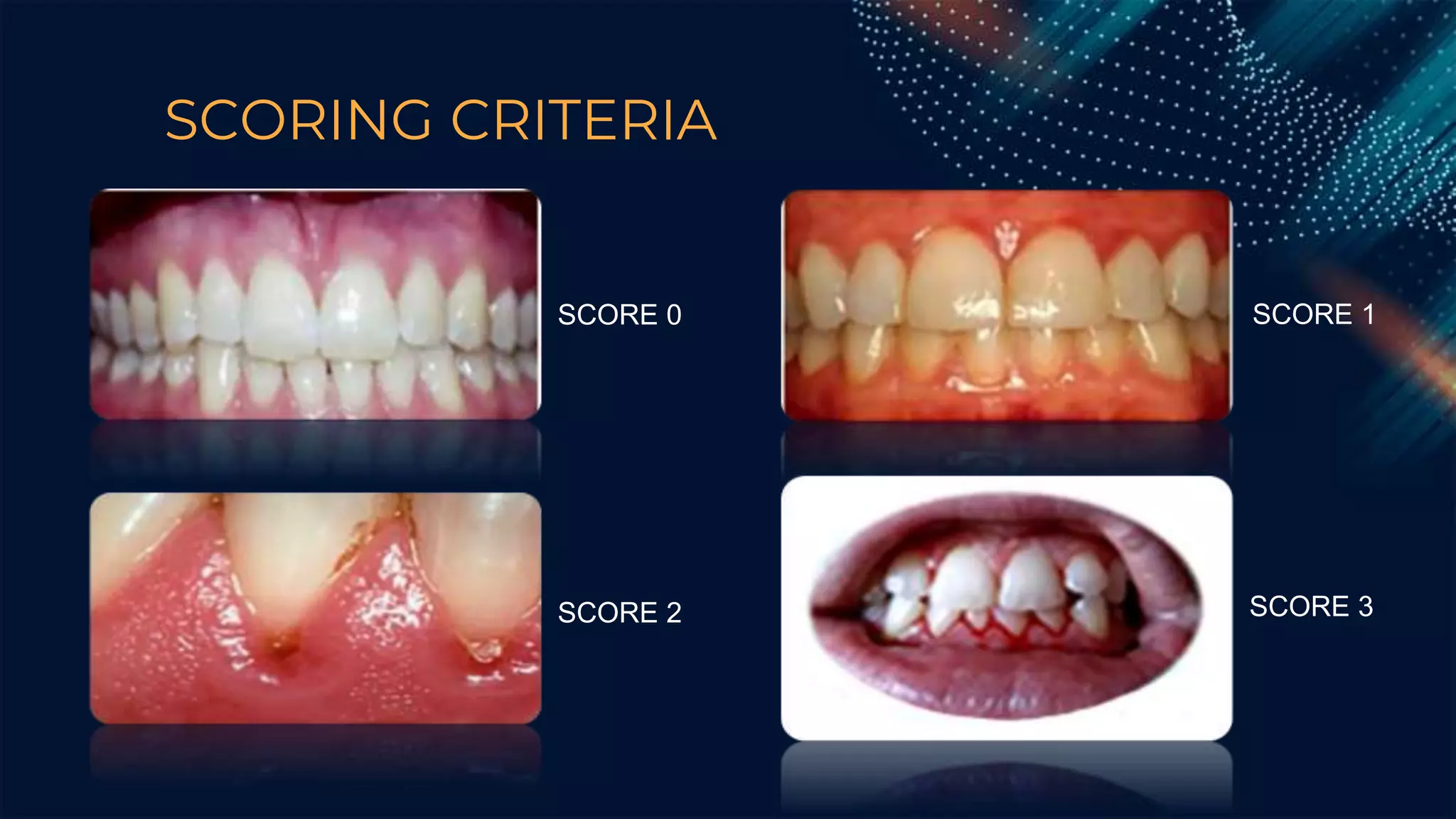 Gingival Index (By Loes and Sillness) | PPTX