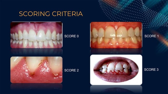 Gingival Index (By Loes and Sillness) | PPTX