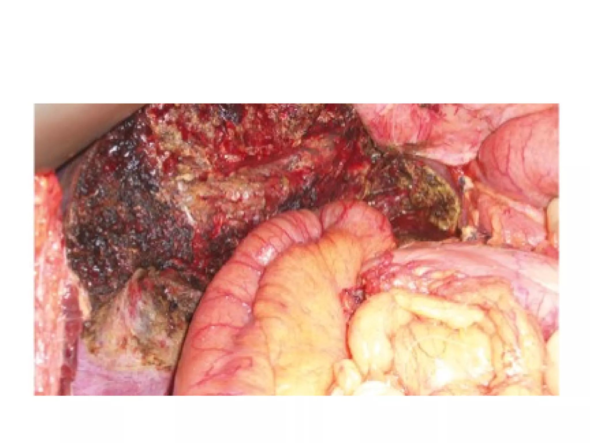 GI bleeding & Intestinal Obstruction | PPT