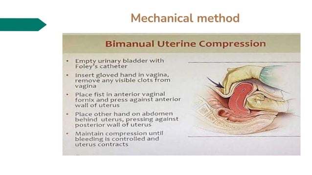 Postpartum_Hemorrhage_By_dr.Redwan.pptx