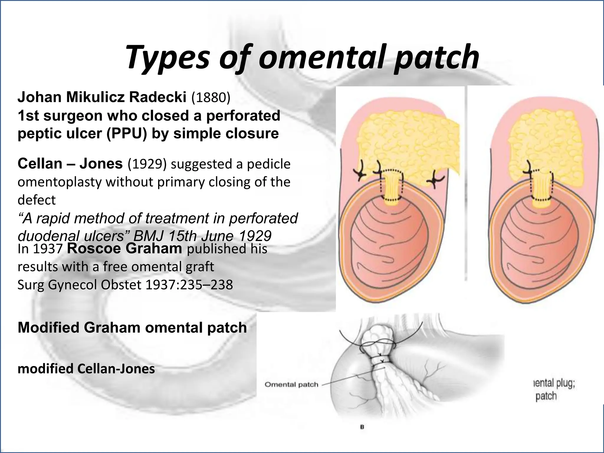 GI1. Surgical Management of PUD 2021.pptx