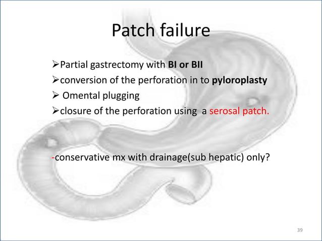 GI1. Surgical Management of PUD 2021.pptx