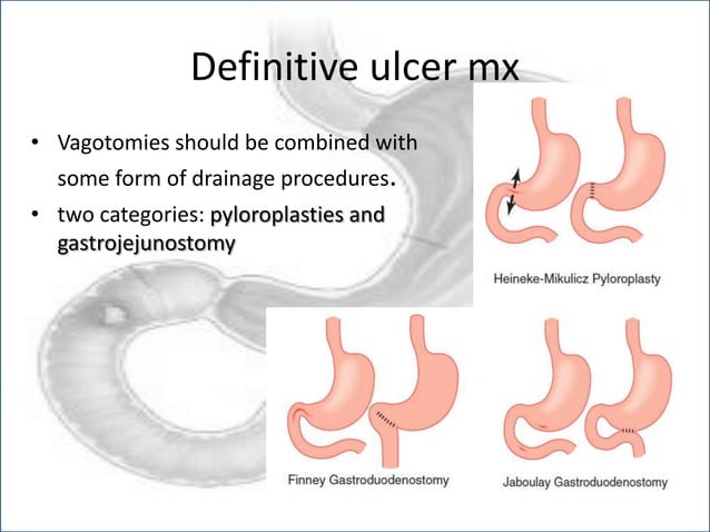 GI1. Surgical Management of PUD 2021.pptx